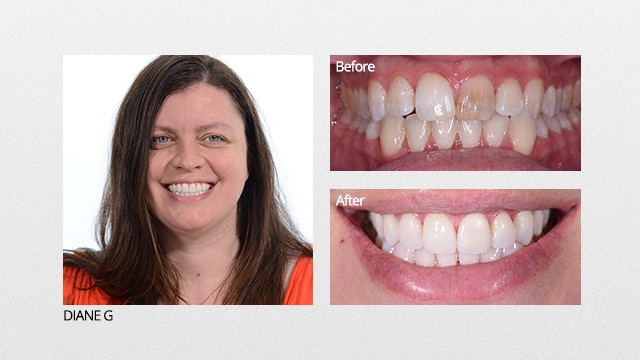 Before After - Aucklands Finest - Glen Innes Dental Centre