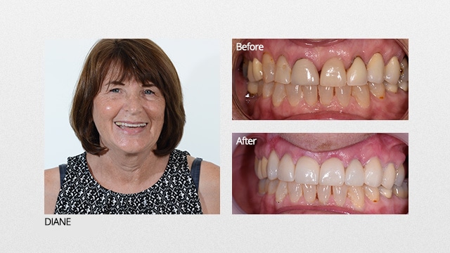 Before After - Aucklands Finest - Glen Innes Dental Centre