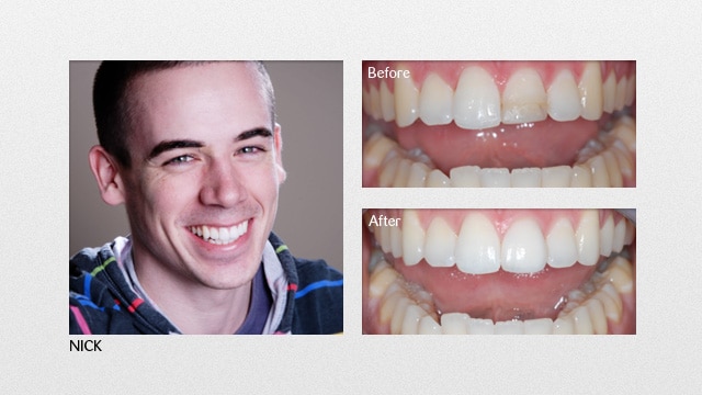 Before After - Aucklands Finest - Glen Innes Dental Centre